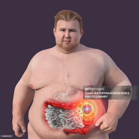 Irritable Bowel Syndrome Illustration High Res Vector Graphic Getty Images