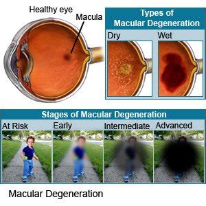 Macular Degeneration Symptoms