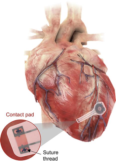 Battery Free Wireless Pacemaker Dissolves Post Treatment Health News