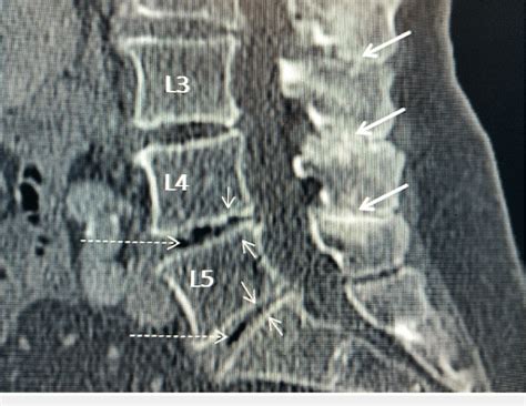 Sagittal Computerized Tomography Ct Scan Showing Kissing Spinous