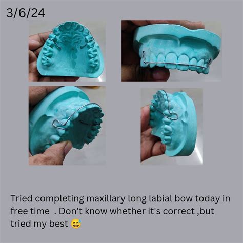 Premieka Muthukumar On Linkedin Just Tried Maxillary Long Labial Bow 😅