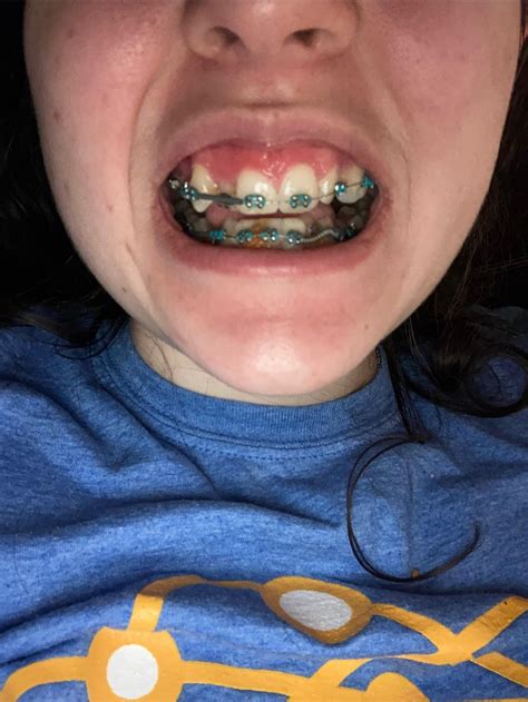 Braces After One Year R Braces
