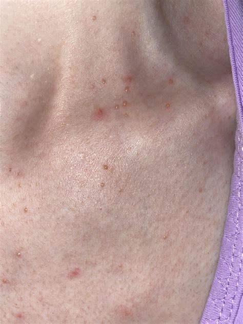 Pityrosporum Folliculitis Chest