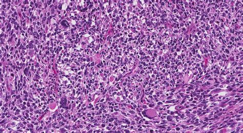 Adenosarcoma Of The Uterus Ottawa Atlas Of Pathology