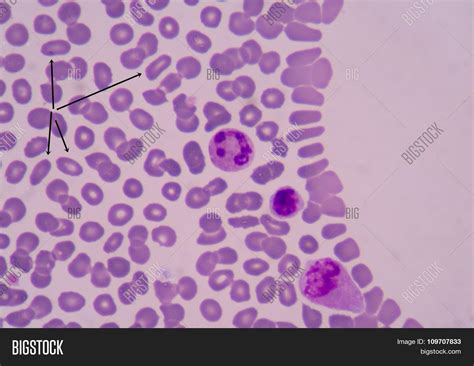Ovalocyte