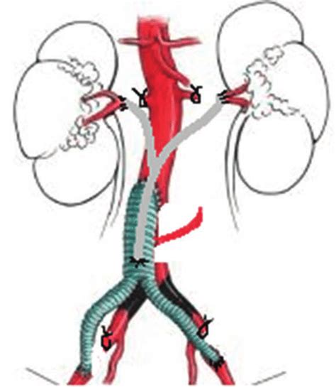 Aortic Reconstruction Aortobifemoral Bypass Graft Surgery Combined