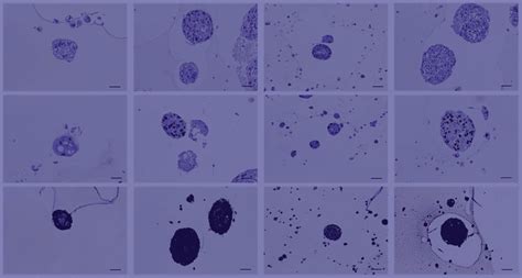 Clinically Relevant Models Of Prostate Cancer Genomescan