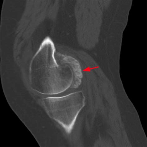 Calcium Pyrophosphate Dihydrate CPPD Crystal Deposition Disease Radsource