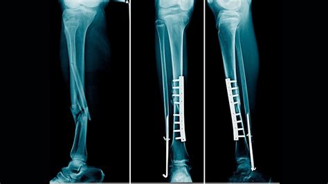 Tibia Fibula Fracture Recovery