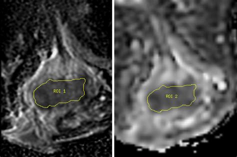 High Resolution Diffusion Weighted Imaging For Monitoring Breast Cancer Treatment Response