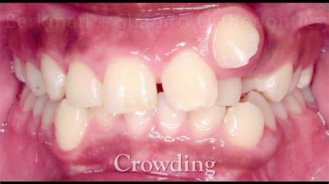 What Causes Dental Crowding At Mary Maxfield Blog