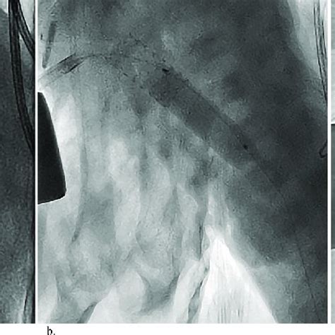 Stent Migration A Image Of The Migrated Stent From The Da To The