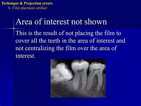 Radiographic Errors And Artifacts Pptx Photo Editing Software Computer Software And
