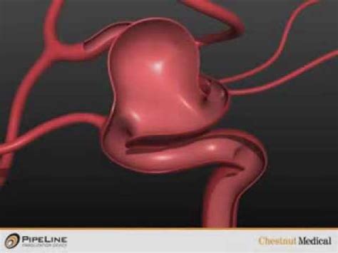 Pipeline Embolization Device Demonstration YouTube