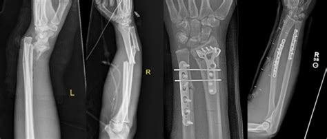 Complex Forearm Fractures East Bay Hand Medical Center Best Hand