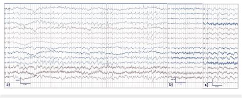 Eeg Recording Of Case 1 Patient Cefepime Level At Day Of Eeg 94 4 Download Scientific Diagram