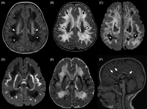 Axial Spin‐echo T1‐ A And Turbo Spin‐echo T2‐weighted Sequences B Download Scientific