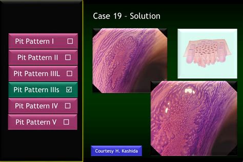 Pit Pattern Classification Colon Explorer