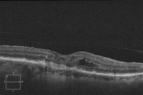 Rpe Rip Macular Oct Retina Image Bank