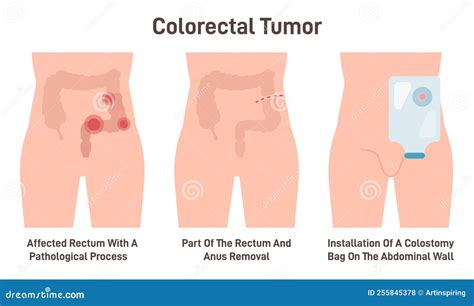 Colostomy Bag Installation Colon Cancer Procedure Stock Vector Illustration Of Rectum