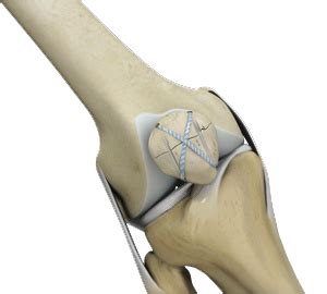 Patella Fracture Treatment And Kneecap Surgery Atlanta Atlanta Bone