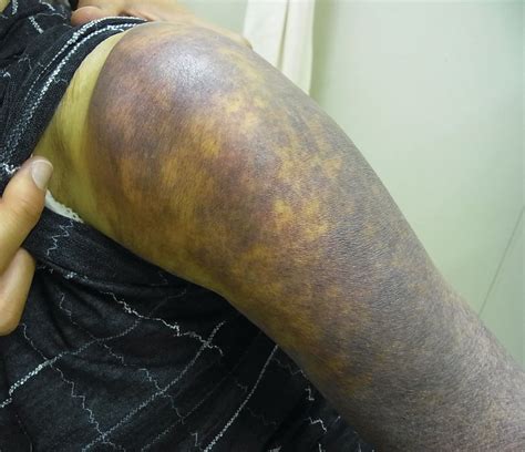 Extensive Ecchymosis Due To Rotator Cuff Tear The Journal Of Rheumatology