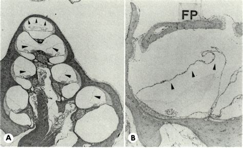Figure 1 From Endolymphatic Hydrops Induced By Immune Response Of The Endolymphatic Sac