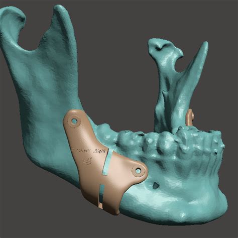 ⚕️ orthognathic surgery case with guides and segmentations・ stl file