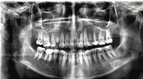 Dental 2 Semantic Segmentation Dataset By Yim