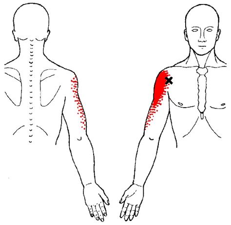 Deltoid Trigger Points And Referred Pain Patterns Trigger Point Self Help