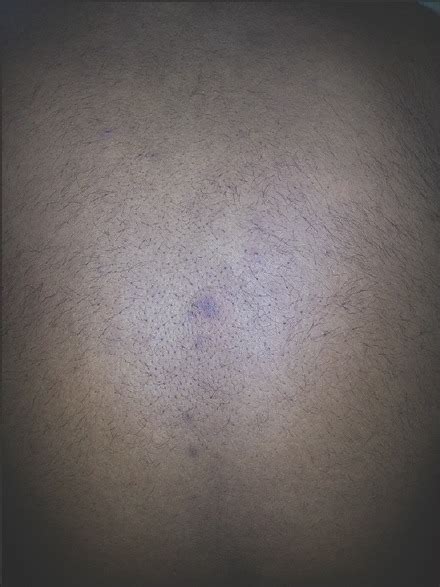 Pseudofolliculitis Corporis A New Entity Diagnosed By Dermoscopy Pmc