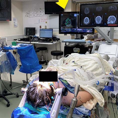 Virtual Reality Based 3 Dimensional Localization Of Stereotactic Eeg Seeg Depth Electrodes And