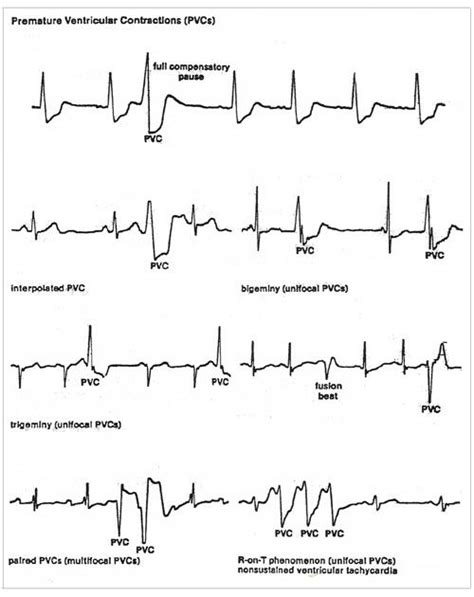 Pvcs Abnormal Heart Rhythm Charts