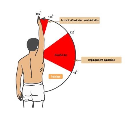 Shoulder Impingement Diagnosis