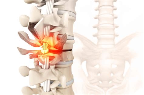 What To Know About Spinal Compression Fractures