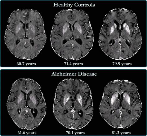 Brain Iron Accumulation Linked To Cognitive Decline In Alzheimers Lifeboat News The Blog