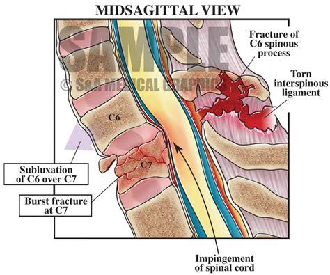 Cervical Spine Injury Sanda Medical Graphics
