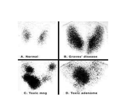 Hyperthyroidism Clinical Features And Its Management Ppt