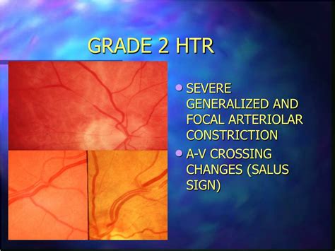 Ppt Hypertensive Retinopathy Powerpoint Presentation Free Download