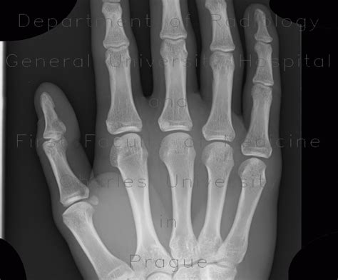 Metacarpal X Ray