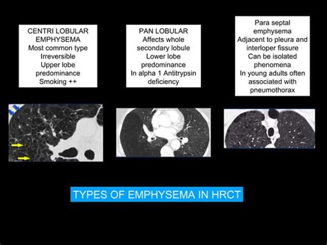 Patterns In Hrct Chest Pptx Lung And Respiratory Health Diseases And Conditions