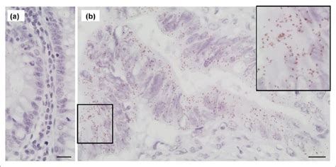 Adam 17 Fhl2 Pla In A Normal Colonic Mucosa And B Colorectal