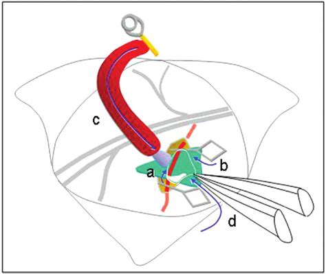 Fluid Infiltration Into The Surgical Field Derives From The Cistern