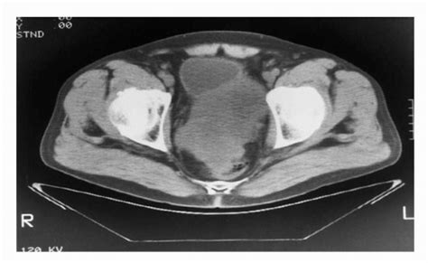 Adult Genitourinary Soft Tissue Sarcoma Oncohema Key