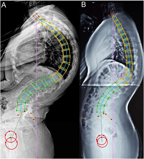 Scheuermanns Sykdom Scheuermann Disease Radiology Case