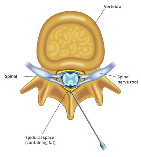 Epidural Labor Injection Epidural Anesthesia Needle Guidance By