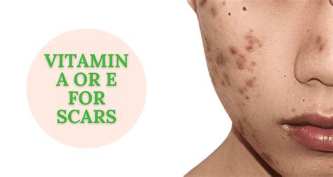 Vitamin A Or E For Scars Which Is Best