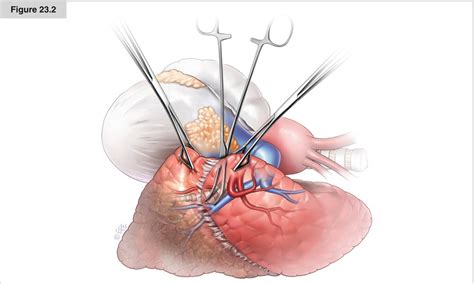 Bronchiectasis Thoracic Key