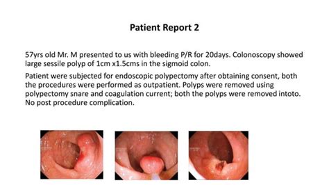Endoscopic Removal Of Colonic Polyps Pptx Medical Health