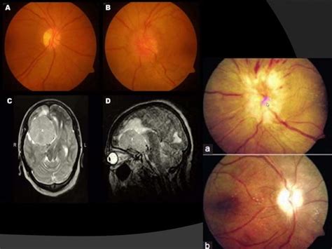 Optic Nerve Optic Atrophy Clinical Round Pptx